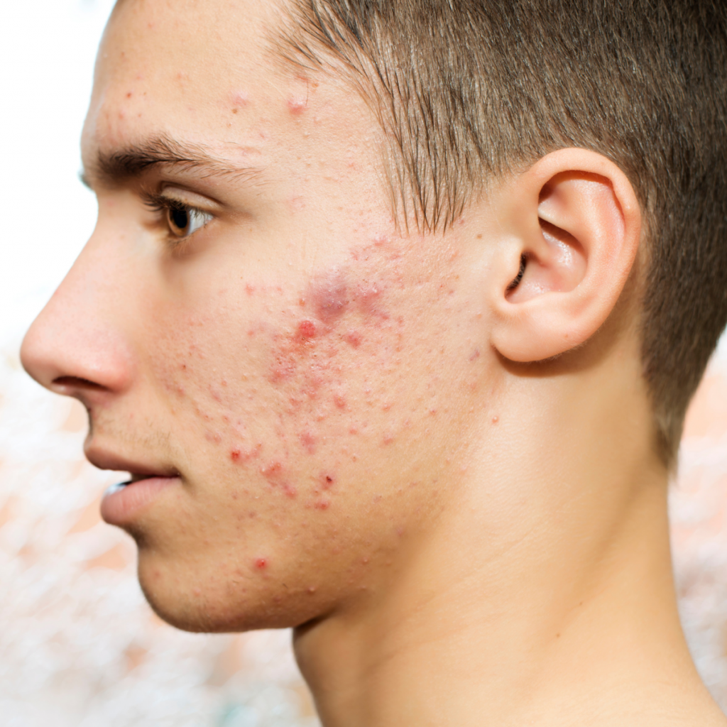 Nodulocystic Acne - MOHO