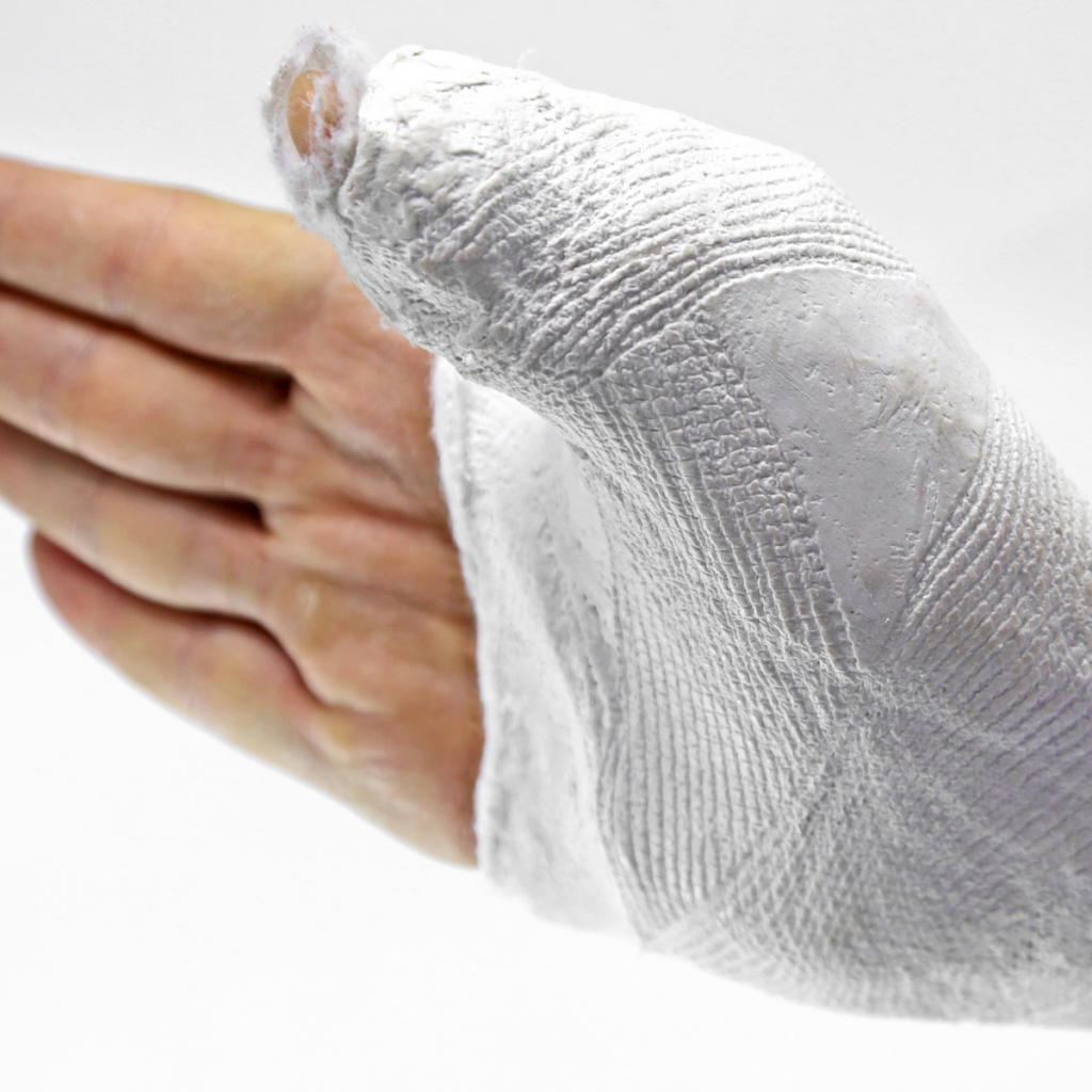 Thumb Fracture - MOHO