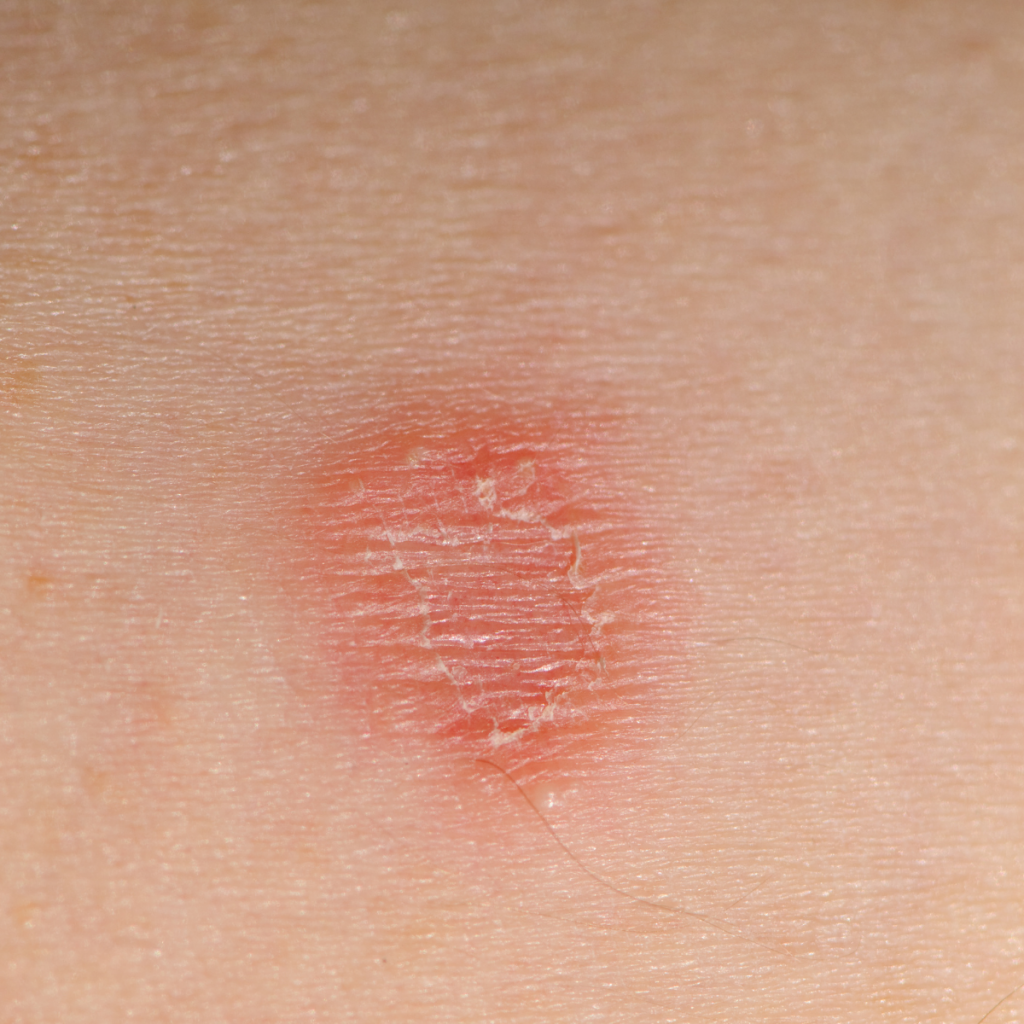 Tinea Corporis (Ringworm Infection, Dermatophytosis) - MOHO